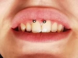 Smiley Piercing 50 Image Ideas jewelry, pros & cons, design & care ...