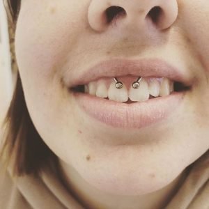 Smiley Piercing 50 Image Ideas jewelry, pros & cons, design & care ...