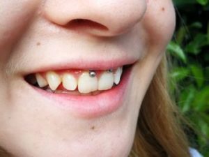 Smiley Piercing 50 Image Ideas jewelry, pros & cons, design & care ...