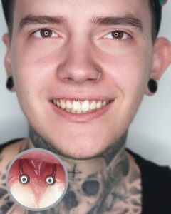 Smiley Piercing 50 Image Ideas jewelry, pros & cons, design & care ...